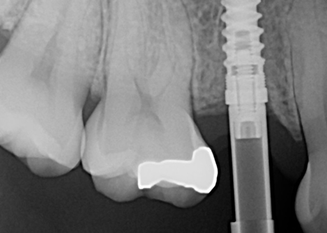 Restoring Dental Implants, 3D Printing for Bite Splints, Sleep Devices ...